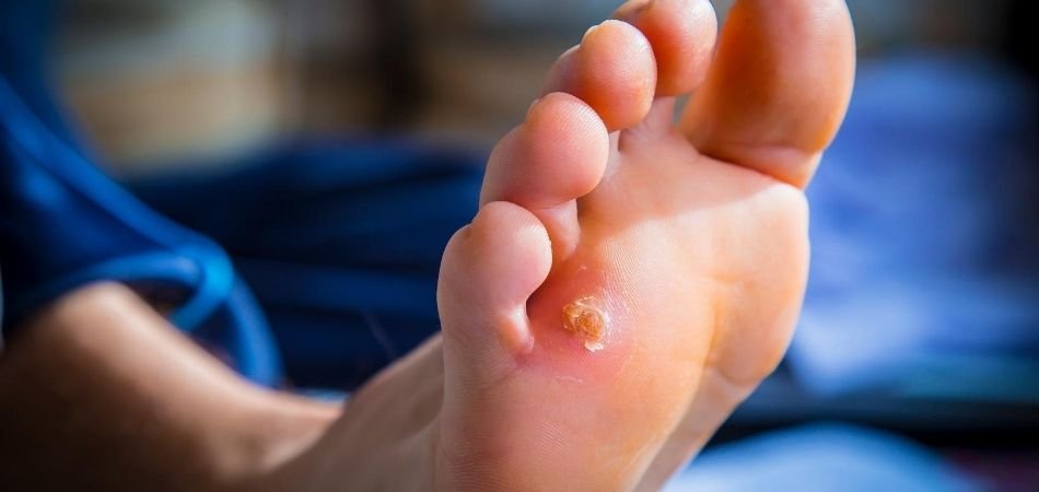 7 Quick Ways To Get Rid of Foot Calluses and Corns – Callus Performance