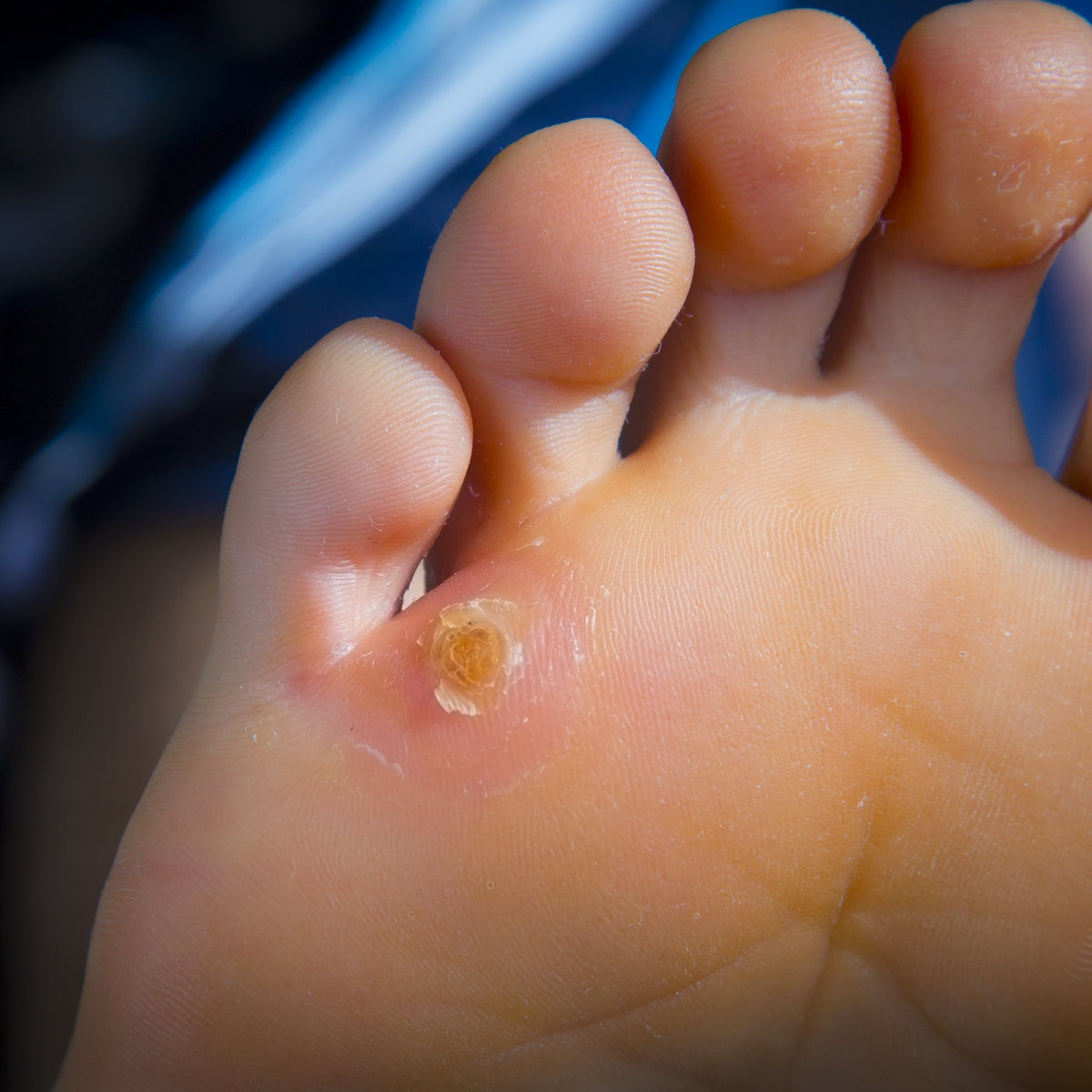 How thick should a callus be? Callus Performance to the rescue