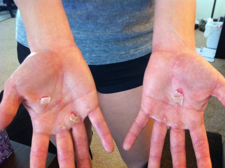 5 EASY STEPS TO HEAL RIPPED AND TORN HANDS – Callus Performance