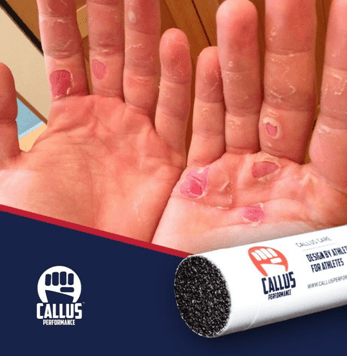 How to Treat Calluses on Hands - – Callus Performance