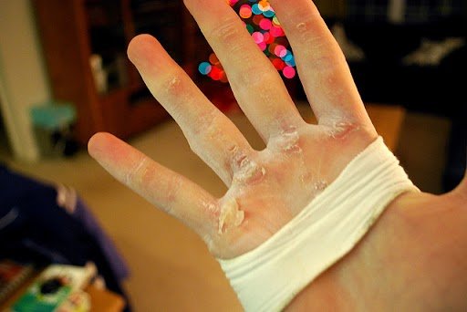 How to treat and prevent ripped Calluses? – Callus Performance